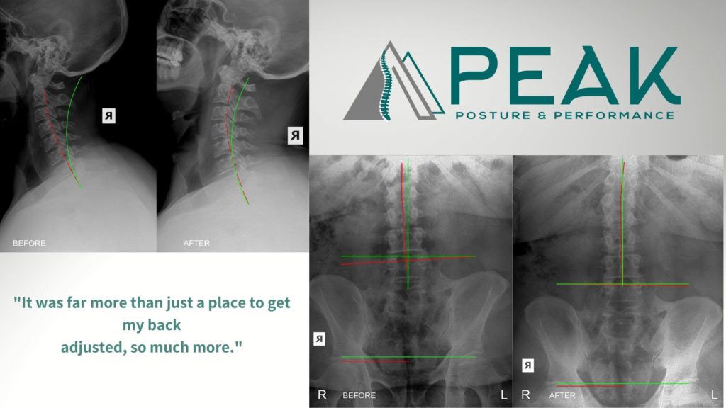 Headaches and Back Pain or Brain Insufficiency? Spine Research is ...